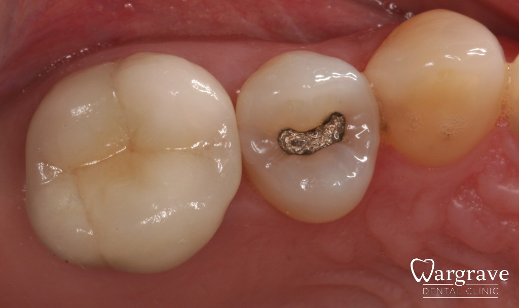 Dental Crowns - Wargrave Dental Clinic