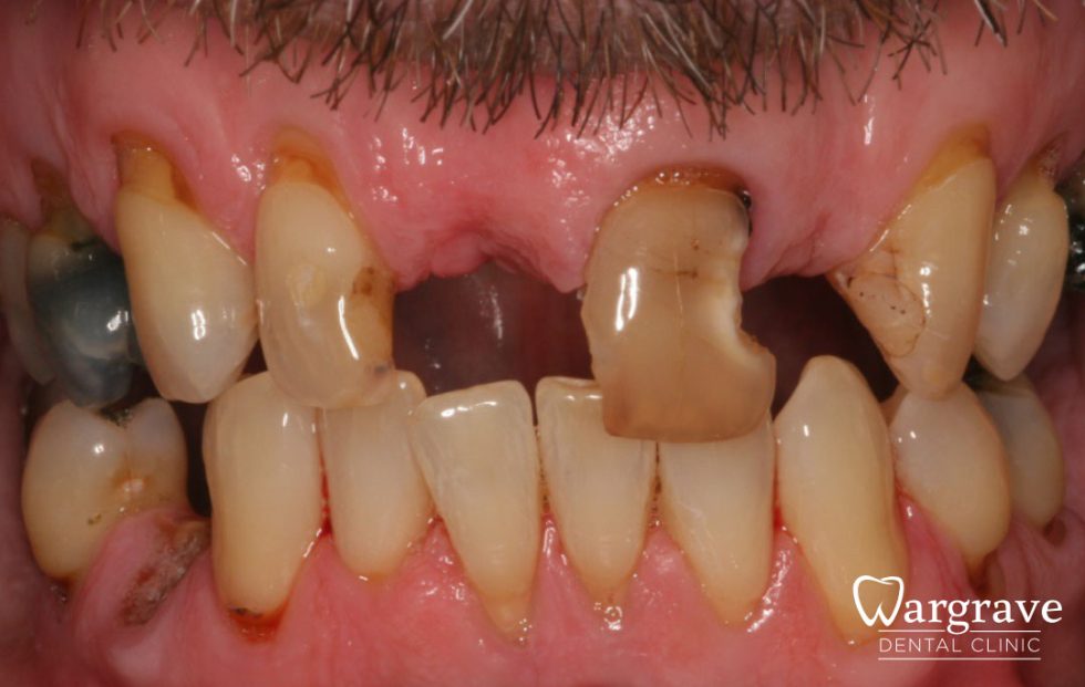 Maxillary Anterior Implant Bridge - Wargrave Dental Clinic